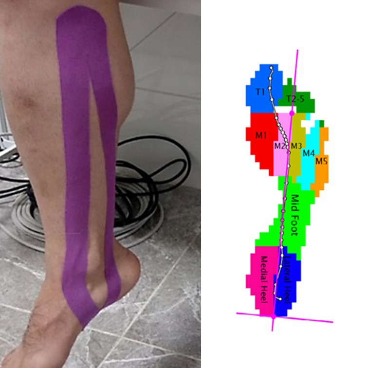 Got “Shin splints”? Kinesiology tape might help. - RockTape